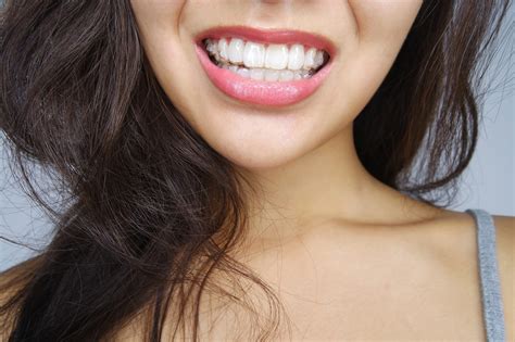 What Are Invisalign Attachments Orthodontist Markham Braces Markham Orthodontist Markham