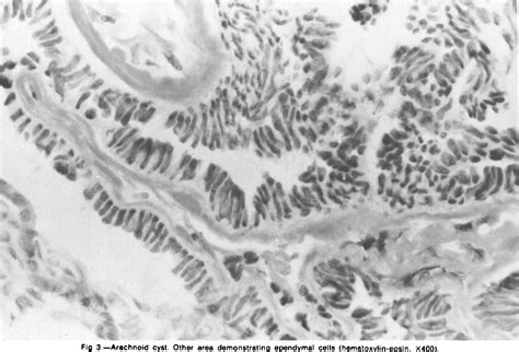 Figure 3 From Arachnoid Cysts Of The Posterior Fossa Semantic Scholar