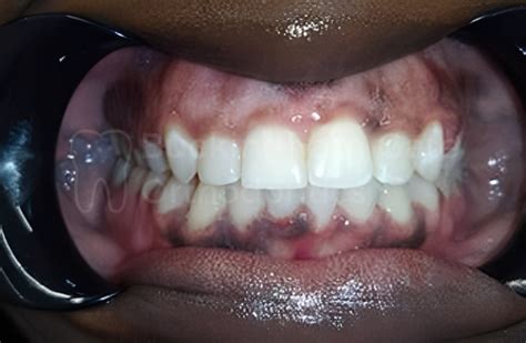 Fixed Braces Buckingham Gate Orthodontics Dentist In London