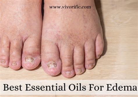 Best Essential Oils For Edema