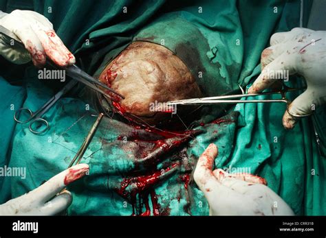 A Neurosurgeon Stitching The Patient S Scalp Back Together To Close The Wound Stock Photo Alamy