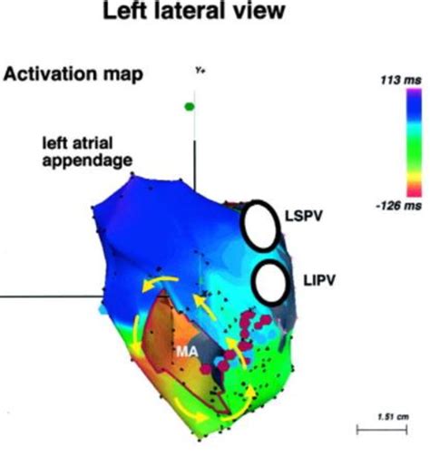 3d Cardiac Map Created Using Navi Star By Biosense Webster [25] Download Scientific Diagram