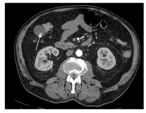 The Many Hidden Faces Of Gallbladder Carcinoma On Ct And Mri Imaging—from A To Z