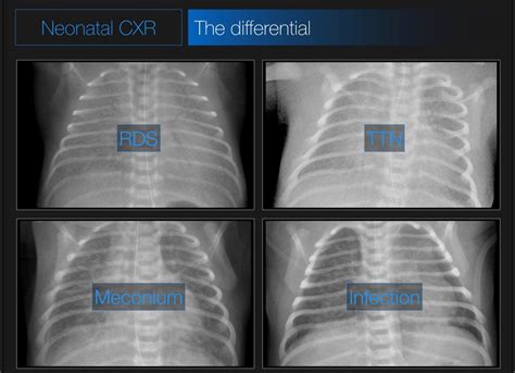 Neonatal X Ray Differential
