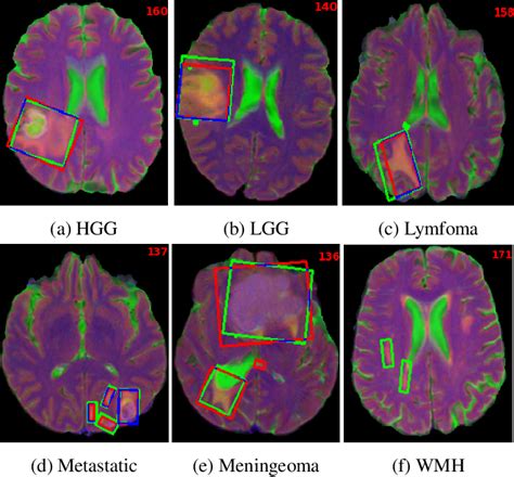 Figure 2 From Brain Mri Screening Tool With Federated Learning Semantic Scholar