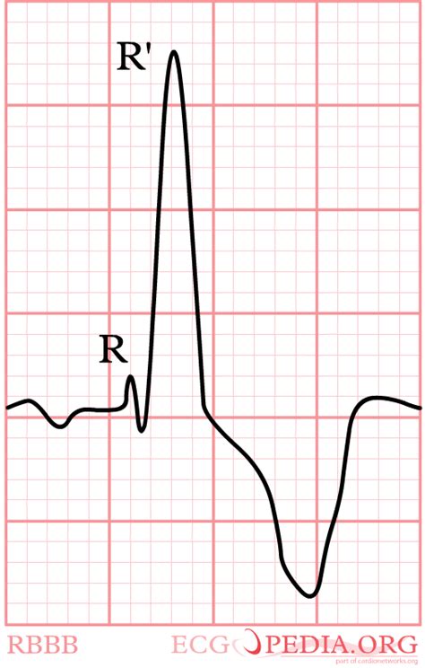 Intraventricular Conduction ECGpedia