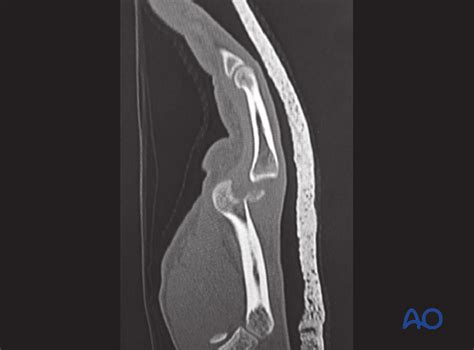 Dislocation And Fracture Dislocation Of The Metacarpophalangeal Joint