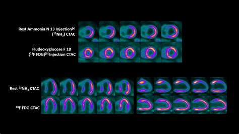 Biograph Mct Petct Scanner Siemens Healthineers Usa