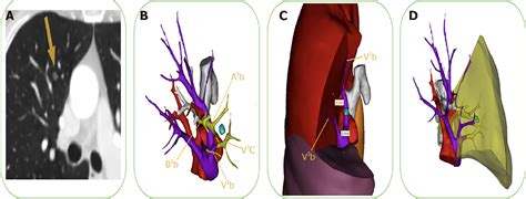 Figure 1 From Thoracoscopic Segmentectomy And Lobectomy Assisted By Three Dimensional Computed