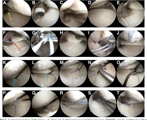 Table 1 From Double Row Root Repair With Bridging Centralization Using