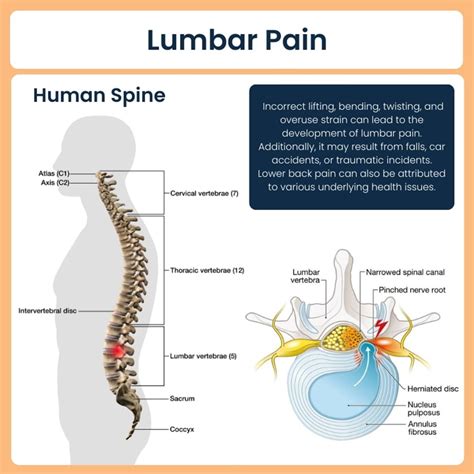 Lumbar Pain What You Need To Know The Spine And Rehab Group