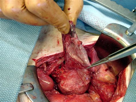 Duodenum Surgery Photos