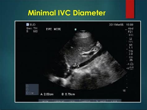 Ivc Guided Fluid Management In The Icu