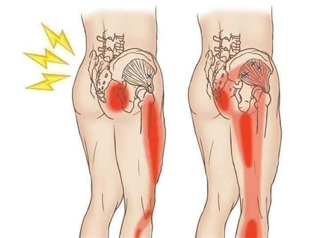 ☝🏻Хөл рүү дагаж өвдөх нь ямар Soyol Med эмнэлэг Facebook