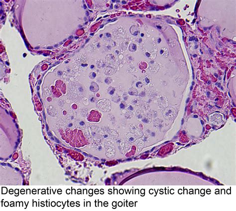 Multinodular Goiter Histology