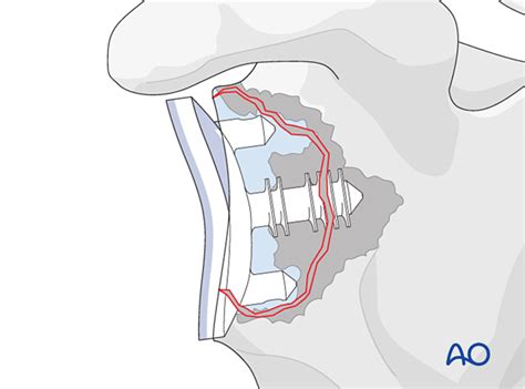 Revision Of An Anatomic All Polyethylene Glenoid Component For Glenoid Implant Loose Good Bone