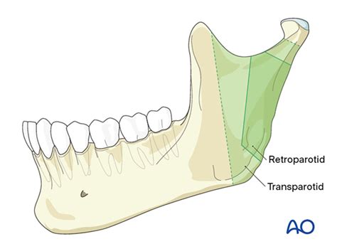 Retromandibular Approaches