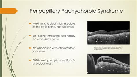 Andreea Moraru Pachychoroid Spectrum Of Diseases Pdf