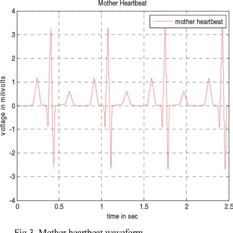Figure 3 From Adaptive Filter Design For Ecg Noise Reduction Using Lms Algorithm Semantic Scholar