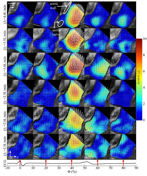 Veno Arterial Ecmo Flows Laboratory For Experimental Fluid Dynamics
