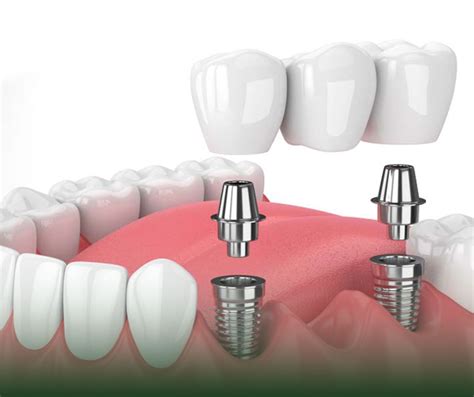 Dantų Implantacija Klinika Armedika