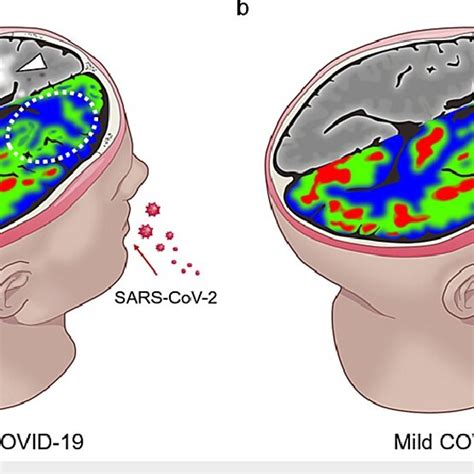 Illustrative Summary Of Frequent Findings On Head Magnetic Resonance