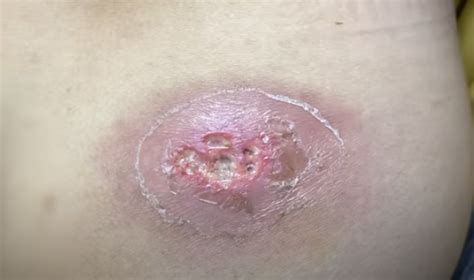 Mrsa Infection Drainage New Pimple Popping Videos