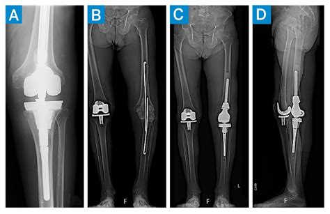 Distal Femur Fracture Surgery