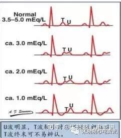 一份心电图就能诊断血钾异常学出新高度 知乎