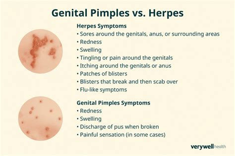 Genital Pimples Vs Herpes How To Tell The Difference