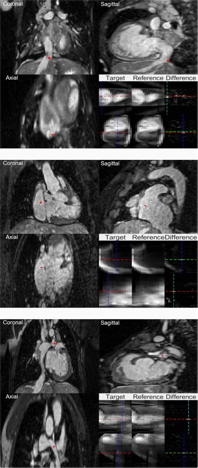 Continuous 3d Catheter Balloon Tracking For Mri Guided Cardiac
