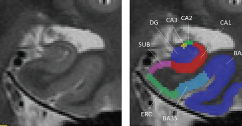 Illustration Of Automatic Segmentation Of The Right Medial Temporal Download Scientific Diagram