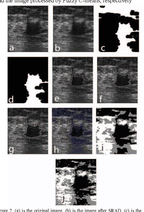 figure 2 from automatic segmentation algorithm of breast ultrasound image based on improved