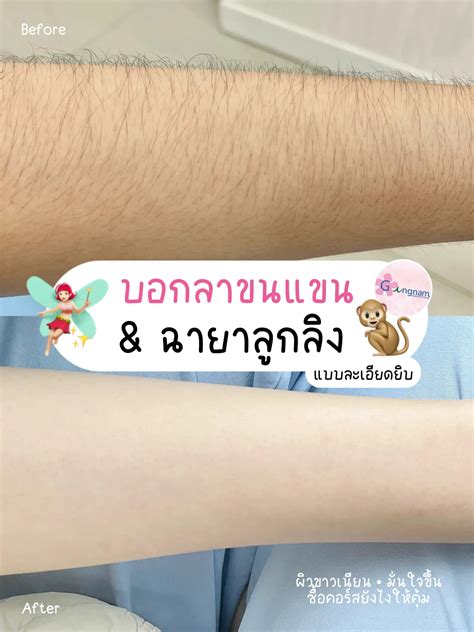 บอกลาขนแขนandฉายาลูกลิง 🐒 ฉบับละเอียดยิบ Gangnam Clinic แกลเลอรีที่โพสต์โดย Ernyanass Lemon8