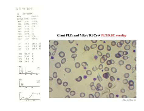 Platelets Histogram Pdf