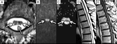 Axial T2 A And Diffusion Weighted B Images Demonstrate T2 Download Scientific Diagram