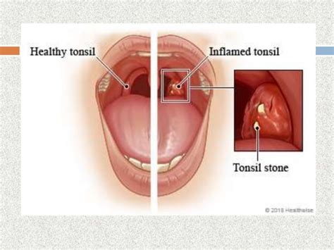 Nursing Management Of The Patient With Tonsillitis Ppt Pptx