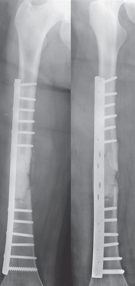 After A Surgical Debridement Comes The First Stage Of The Modified Download Scientific Diagram