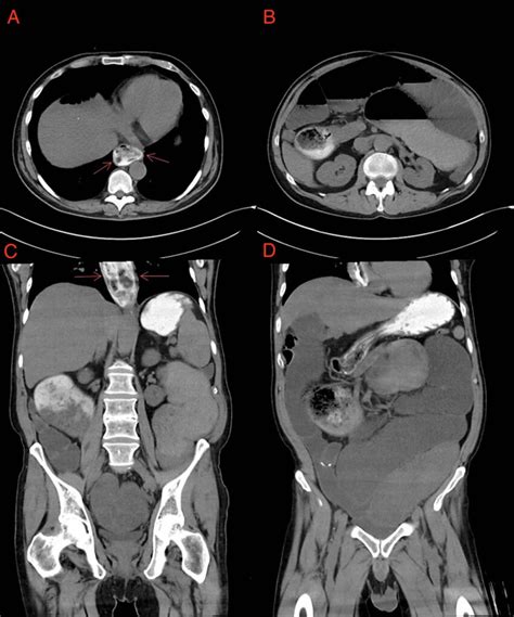 Abdominal Computed Tomography With Oral Contrast A And B Axial View Download Scientific