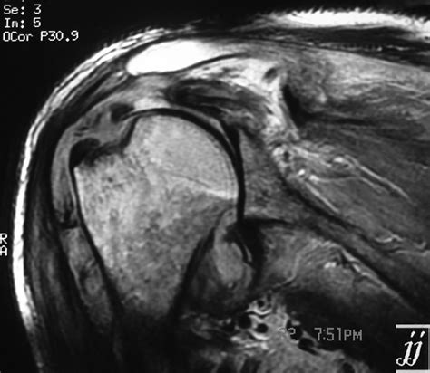 Msk Humeral Greater Tuberosity Erosion Defect Adjacent Tumefaction And Proximal Humerus