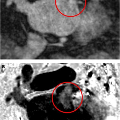 Left Atrial Appendage Thrombus Indicated With A Red Arrow On Tee Heart