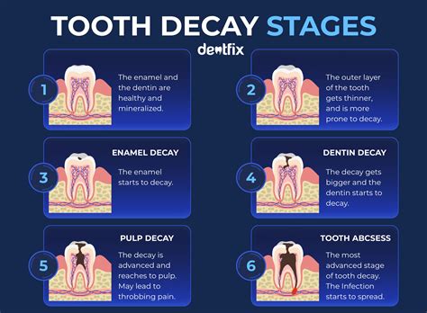 How Do Dentists Fix Tooth Decay Dentfix