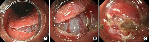 The Circumferential Mucosal Incision Without Bleeding A B The
