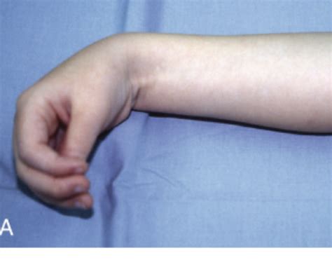 Muscle Tone And Spasticity Flashcards Quizlet