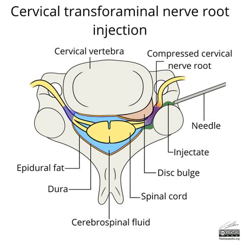 Nerve Root Diagram Cervical Transforaminal Nerve Root Injection
