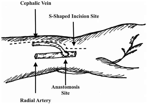 S Shaped Skin Incision Demonstrating The Position Of The Incision To Download Scientific