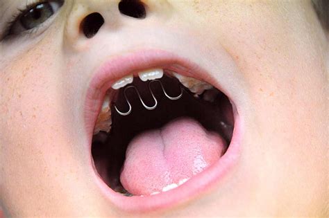 Tongue Crib Without Braces At Harrison Dunckley Blog