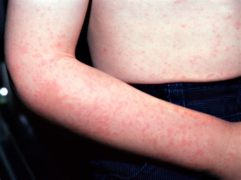 Erythematous Rash