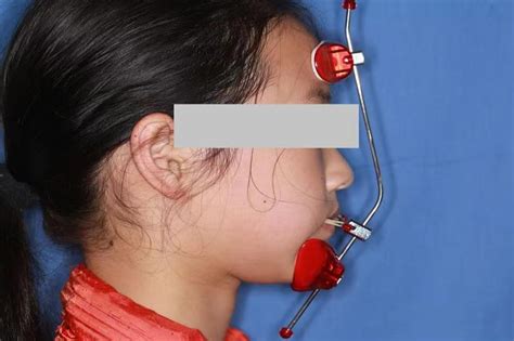 上颌前方牵引器图片