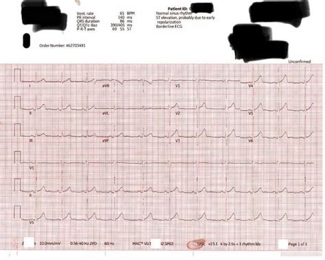 Pre Op Ekg Post Op Chestback Discomfort Raskcardiology
